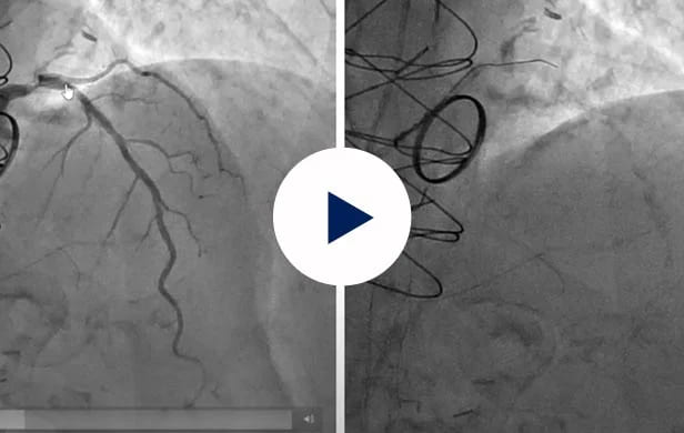 Coronary Interventions - Teleflex