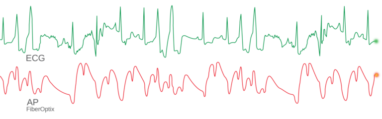 The AC3 Optimus™ Intra-Aortic Balloon Pump