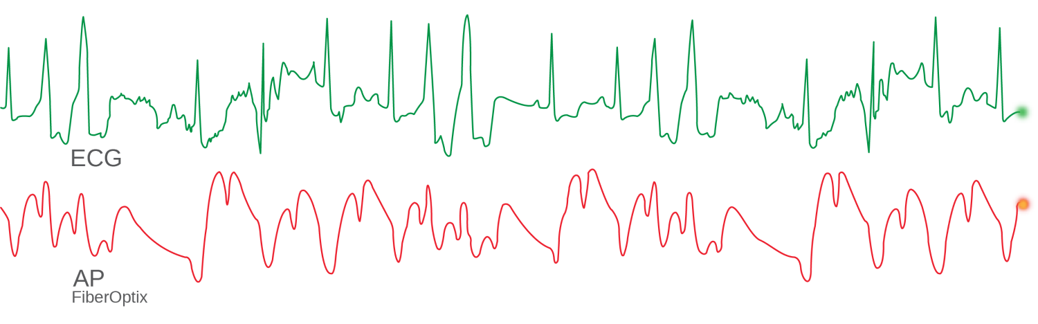 The AC3 Optimus™ Intra-Aortic Balloon Pump