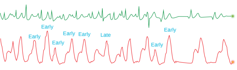 The AC3 Optimus™ Intra-Aortic Balloon Pump